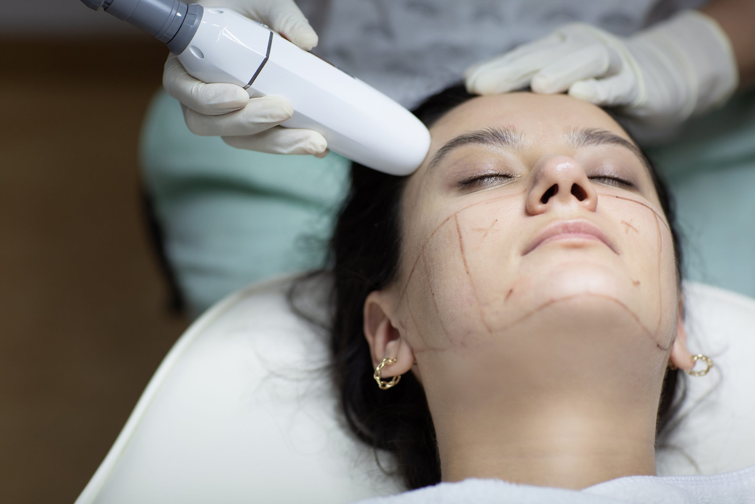 HIFU Technology | AgeLess Clinic